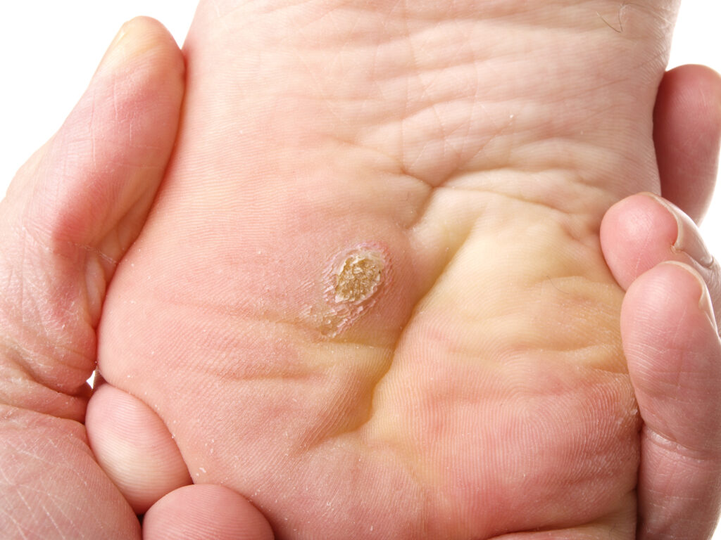 Warts - McLean Dermatology & Skincare Center