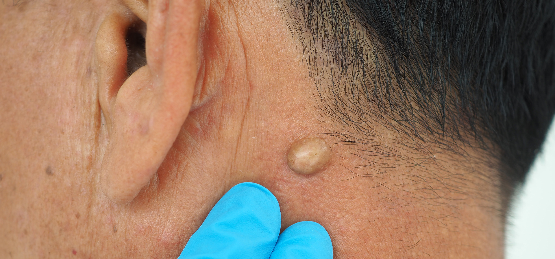 Lipoma
