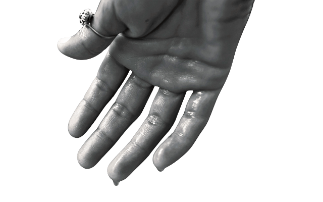 National Hyperhidrosis Month: Understanding and Treating Excessive ...